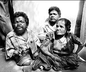 Genetic disorder: Three midgets in a family