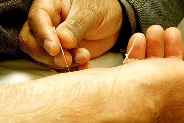 Acupuncture for neuro-disorders