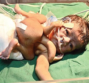 Eight-limbed Baby No More After Surgery