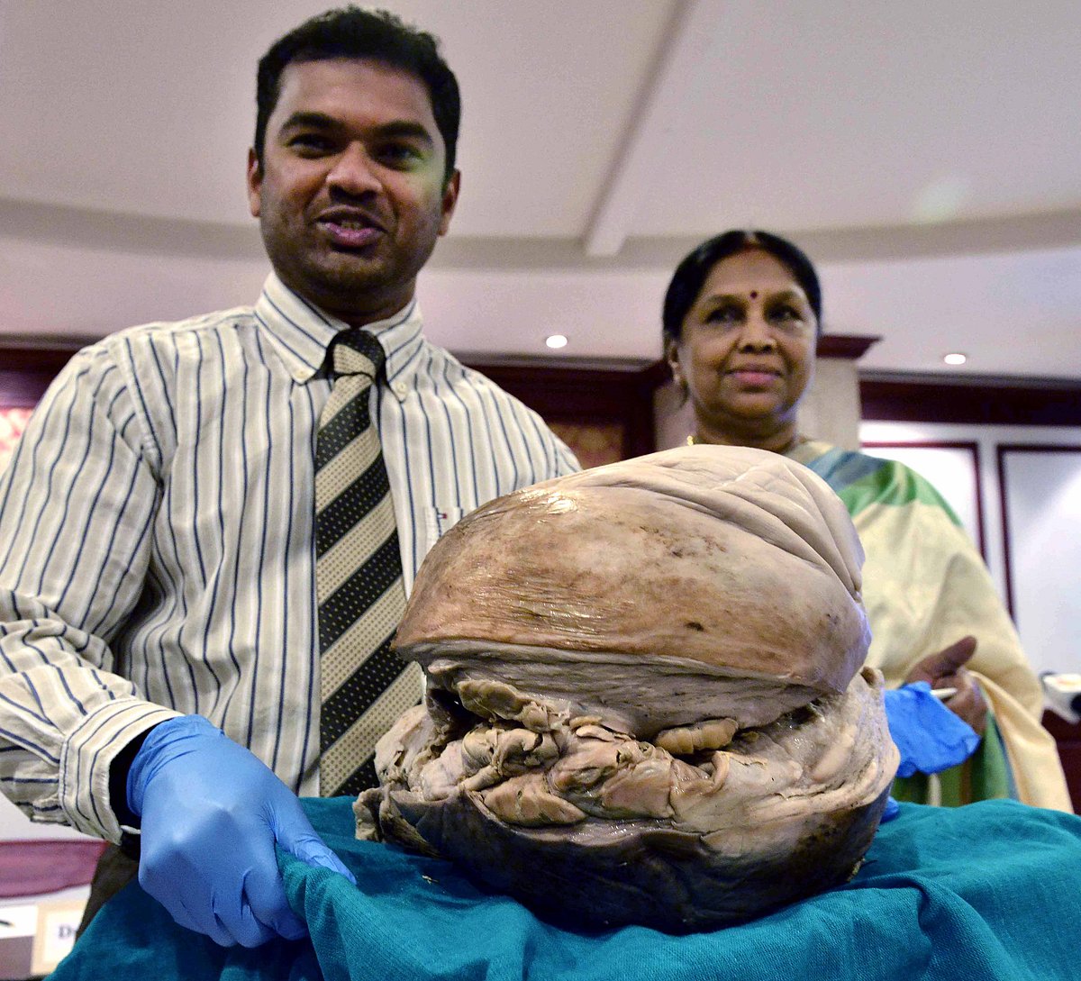 Docs Remove Super-giant Uterine Fibroid via Surgery