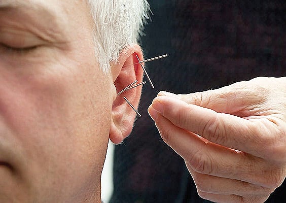 Acupuncture for Military PTSD Found Effective