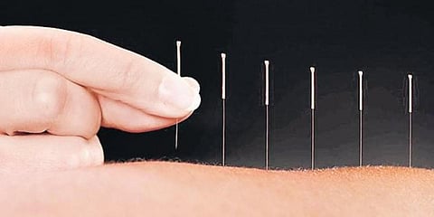 Acupuncture, the Japanese Way