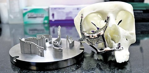IIT-M’s 3D-printed face implants a boon for mucor patients