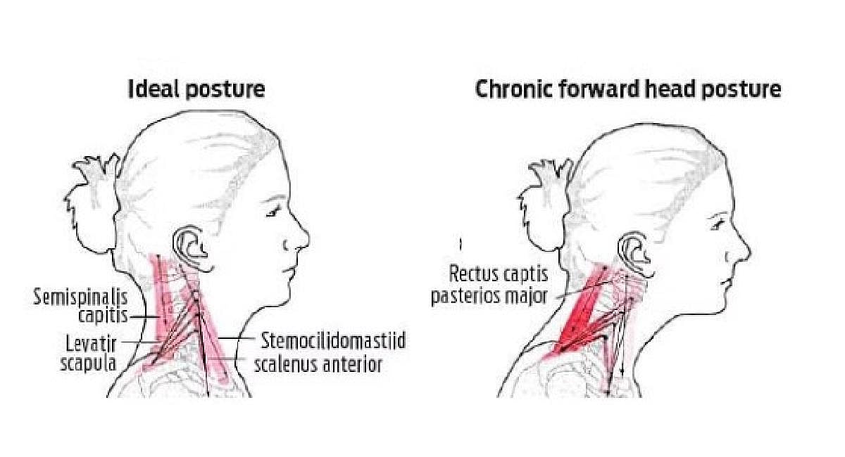 Tackling the Text Neck Syndrome