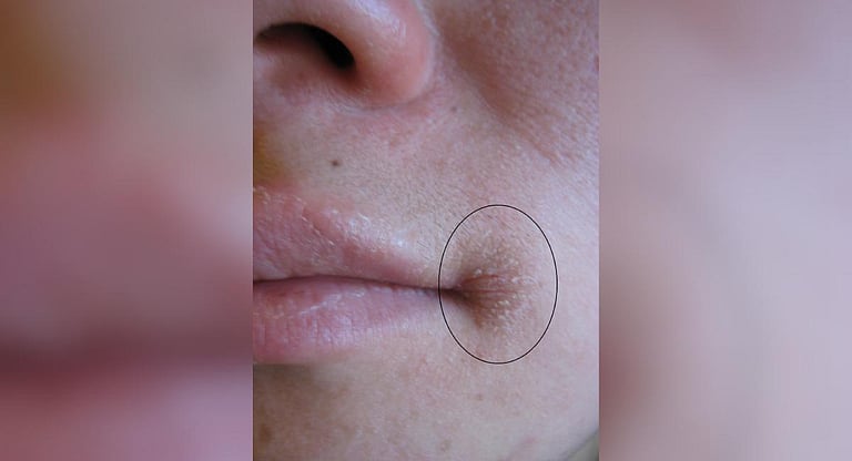 Tangles and dangers of Angular Cheilitis