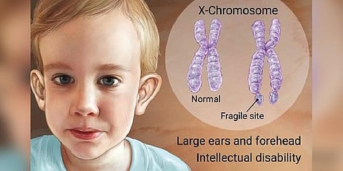 Fragile X factor: Check out a rare genetic condition that impacts ...