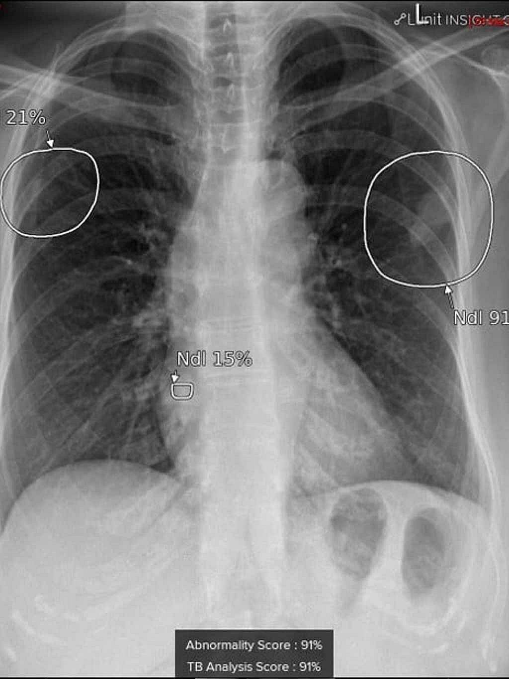 AI Revolutionizes Chest X-ray Analysis