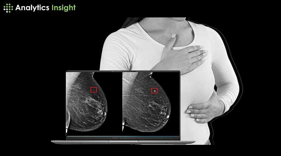 England to Launch Major AI Trial for Faster Breast Cancer Screening