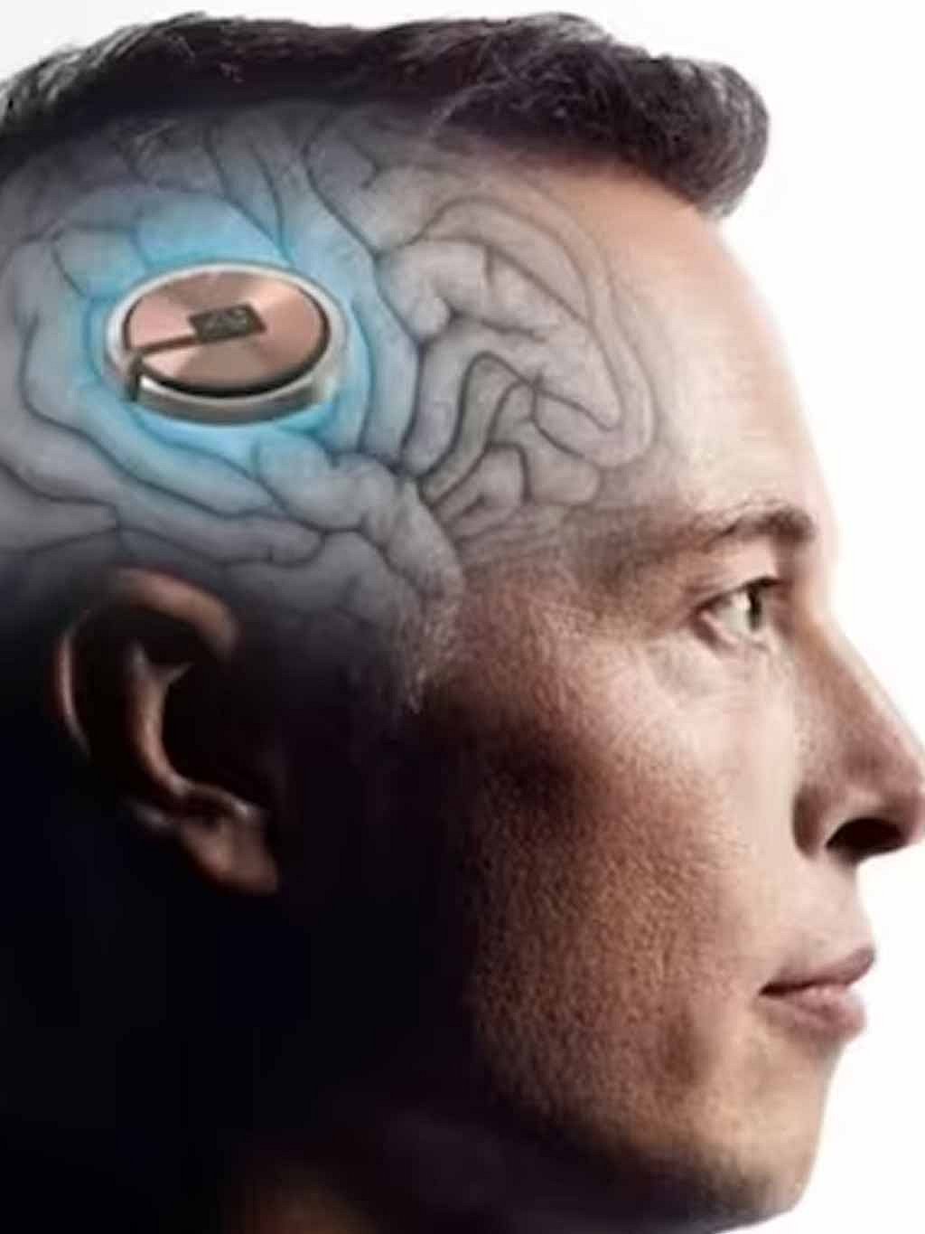Neuralink's First Human Brain Chip by Elon Musk