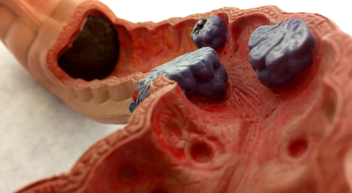 Colon cancer study findings are misleading – AGA statement