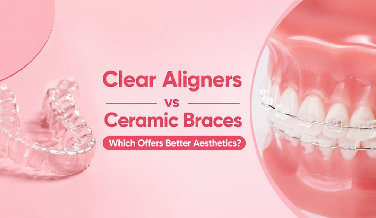 Clear Aligners vs Ceramic Braces Which offers better aesthetics