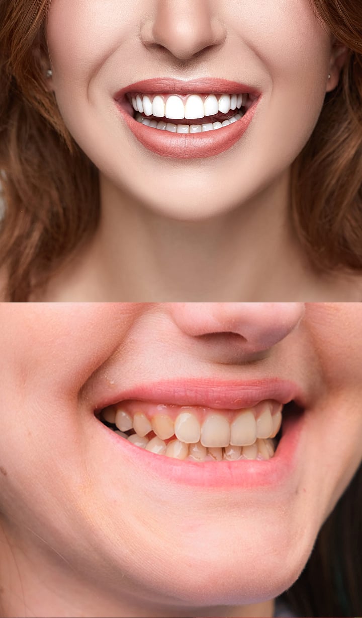 Teeth Care Tips: आता महागडे ट्रीटमेंट नको, 'हे' घरगुती उपाय दातांना ...