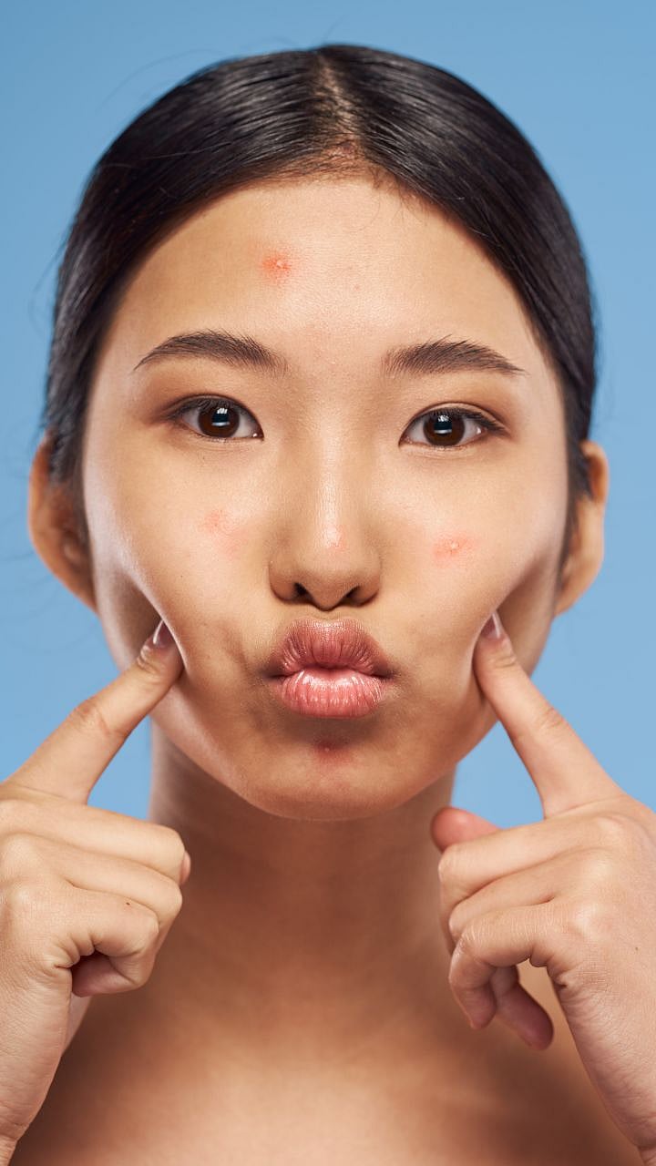 Pimple Prevention: पिंपल से परेशान? 'हे' उपाय करा, मिळेल आराम Pimple ...
