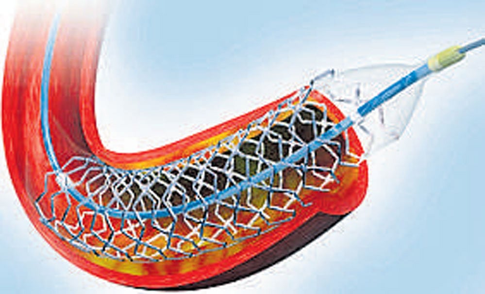 Made in India Stent Triumphs: Supraflex Cruz Bests US Leader Xience