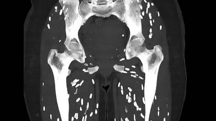 CT scan