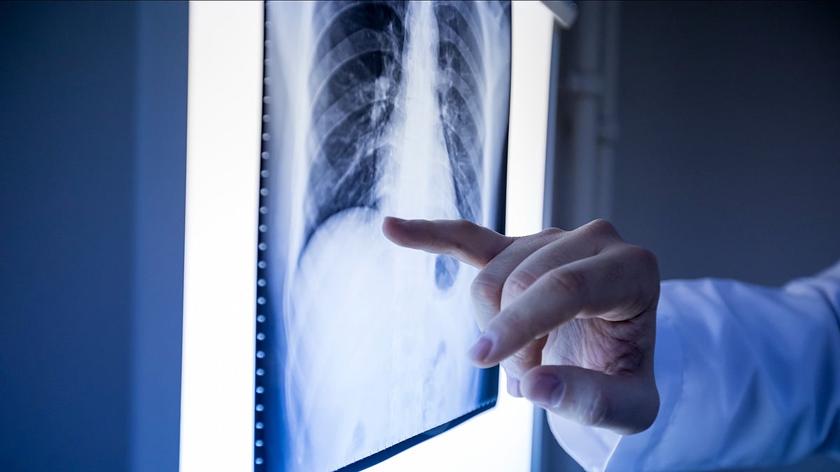 Highly toxic Gallium instrumental in bone cancer treatment: Report
