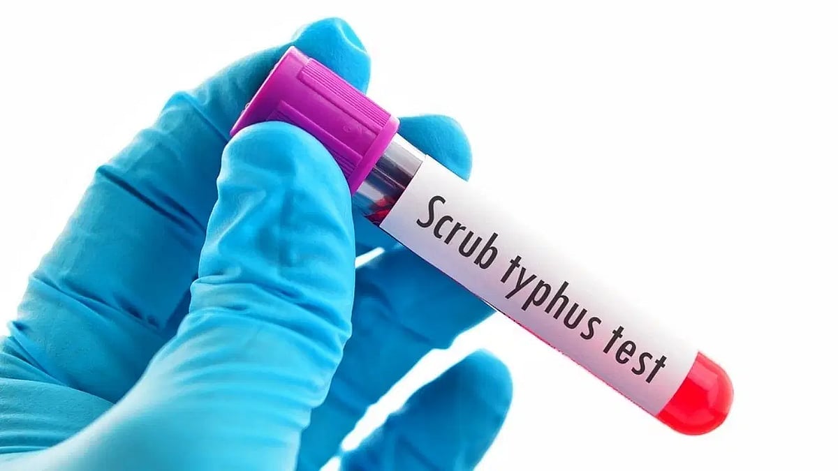 Scrub typhus behind fever-related hospitalisations?