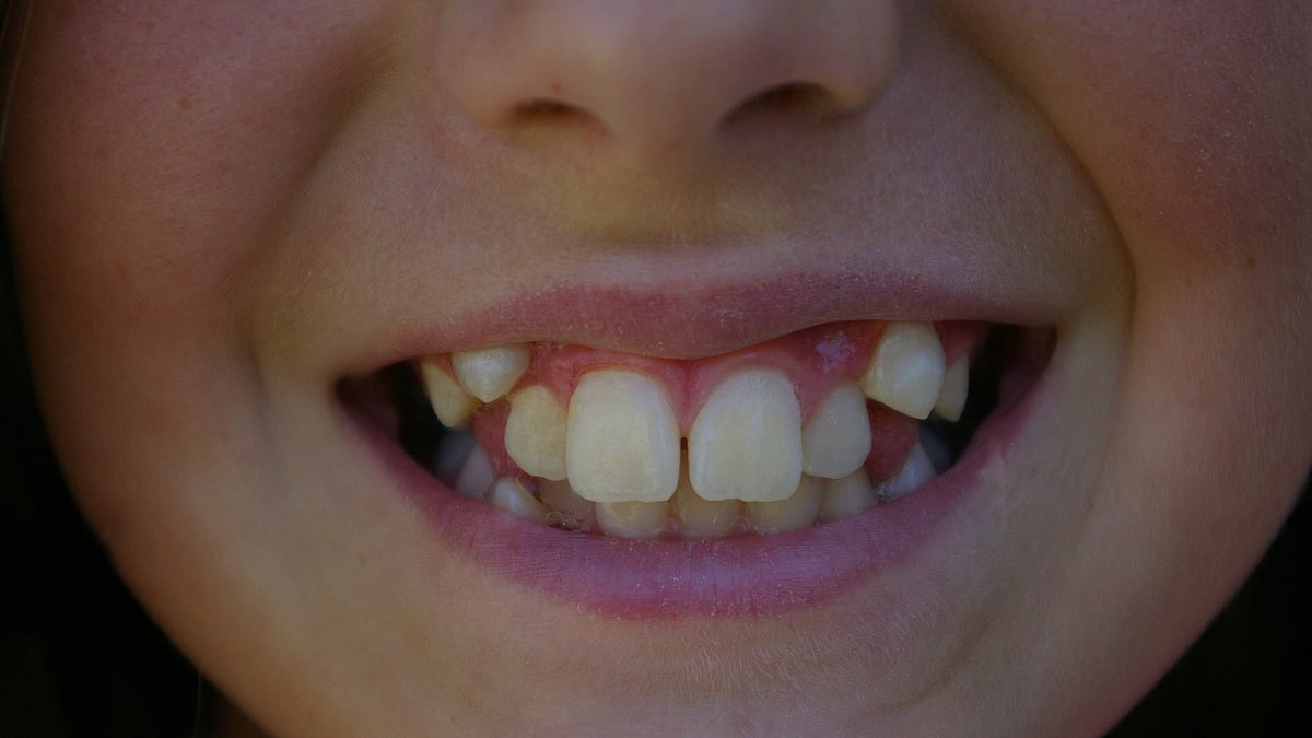 Kerala: Protruding teeth no more grounds for disqualification from ...