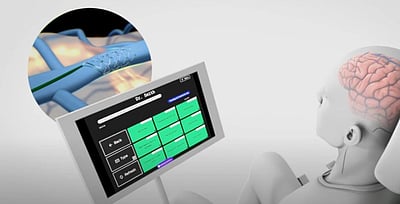 BCI Breakthrough: Apple teams up with Synchron on Brain-Computer ...