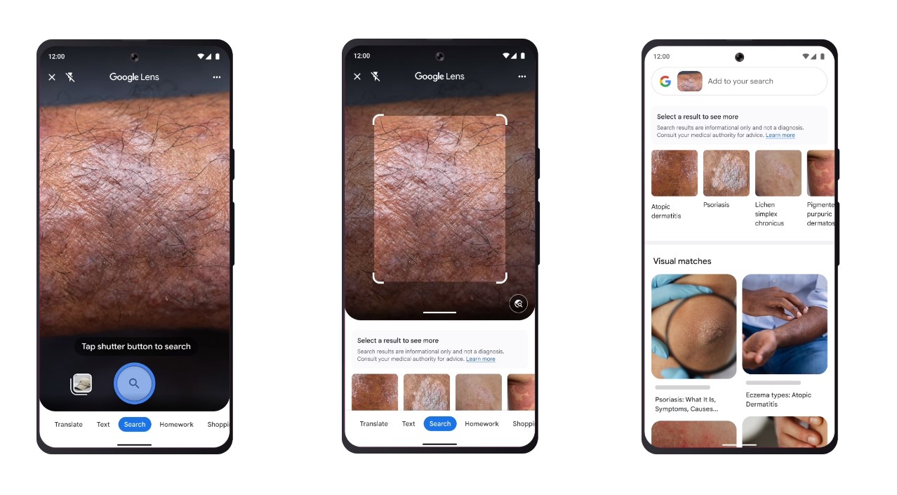 Google Lens gets new feature to help identify skin conditions
