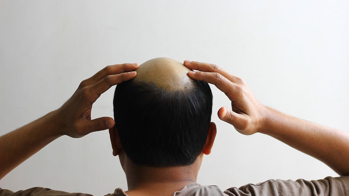Bald men's association in Telangana bristles at lack of pension, want ...