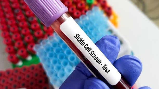 6 crore people screened for sickle cell disease: Health ministry