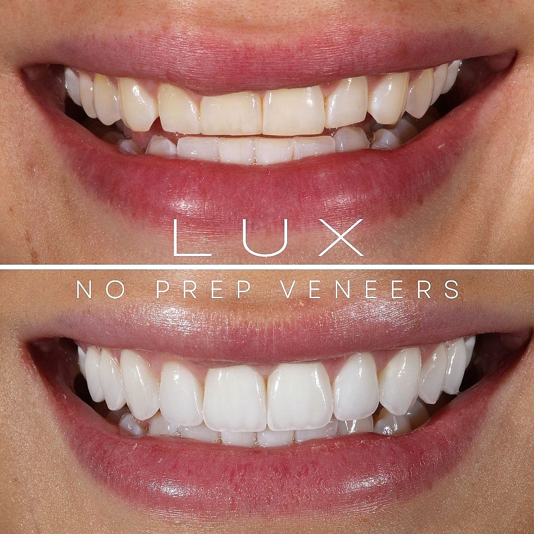LUX No Prep Veneers in Chandler, AZ |Cosmetic Dentist Dr. James Heaton