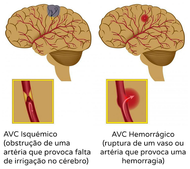 AVC e Recuperação: Como Voltar a Ter uma Vida Boa Após o Acidente ...