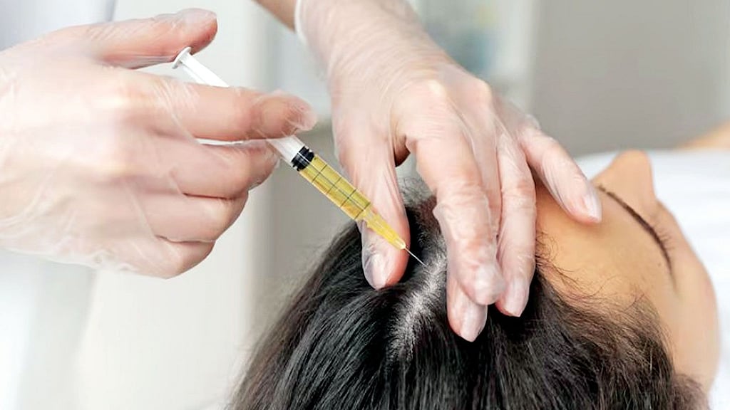 SVF Therapy: Advanced Stem Cell Treatment Revolutionizes Hair Growth