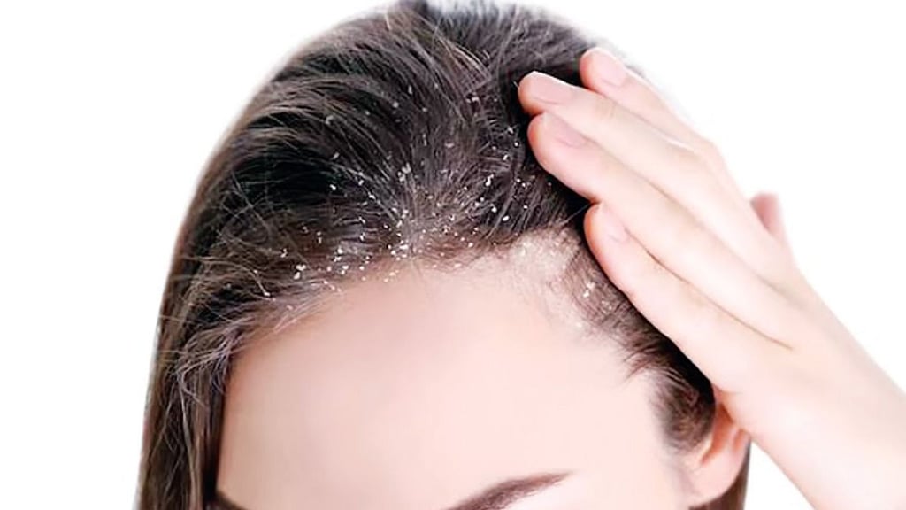 DT Tress Talk | From dandruff to pattern baldness: Treatments for hair ...