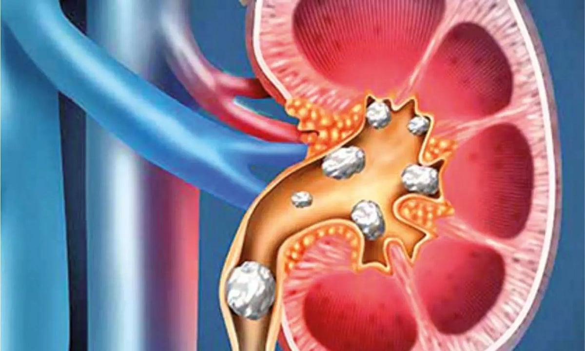 12 mm kidney stones removed from 1-year old