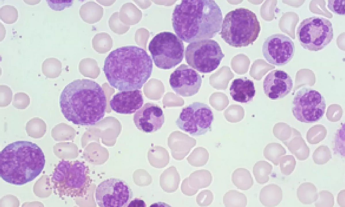 How targeted therapies are boosting outcomes for bone marrow cancer