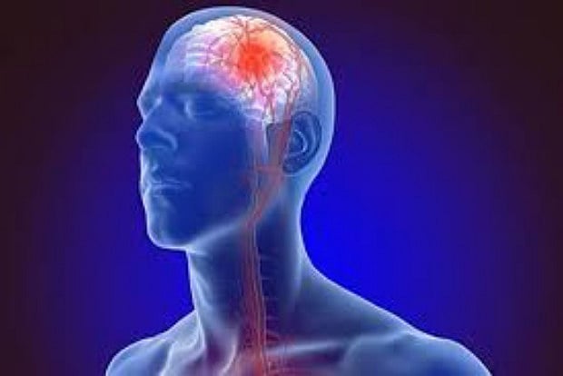 A mini stroke vs regular stroke