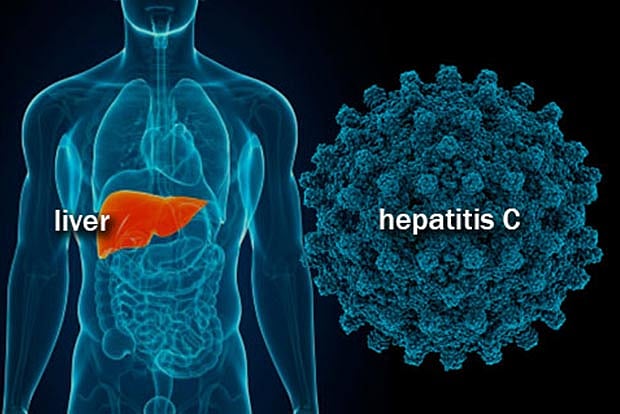 Hepatitis C is curable