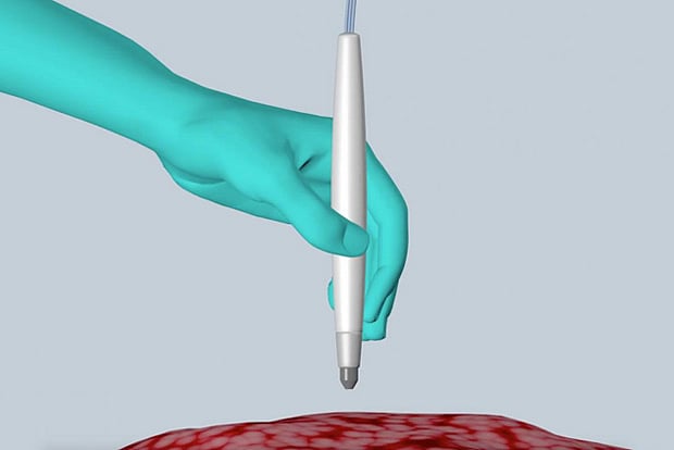 'Pen' to identify cancer in 10 seconds