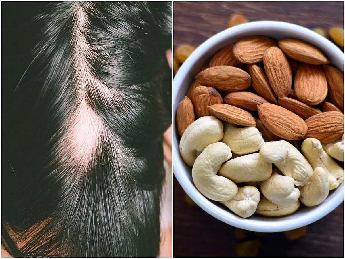 Nuts For Hair: মুঠো মুঠো চুল উঠে মাথায় টাক পড়ে যাচ্ছে কি? ঘন চুল ফিরে ...