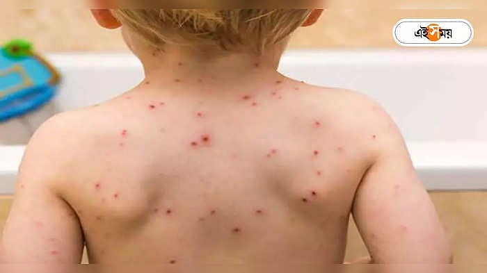 Chicken Pox New Strain : ইউরোপ-যোগেই কি ভারতে নয়া স্ট্রেন জলবসন্তের ...