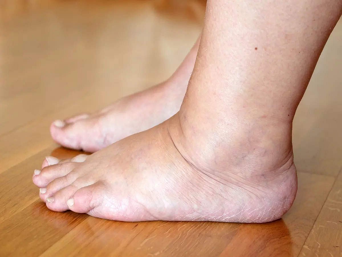 Feet and Fingers Swelling In Winter Causes, Know How to Cure - শীত এলেই ...