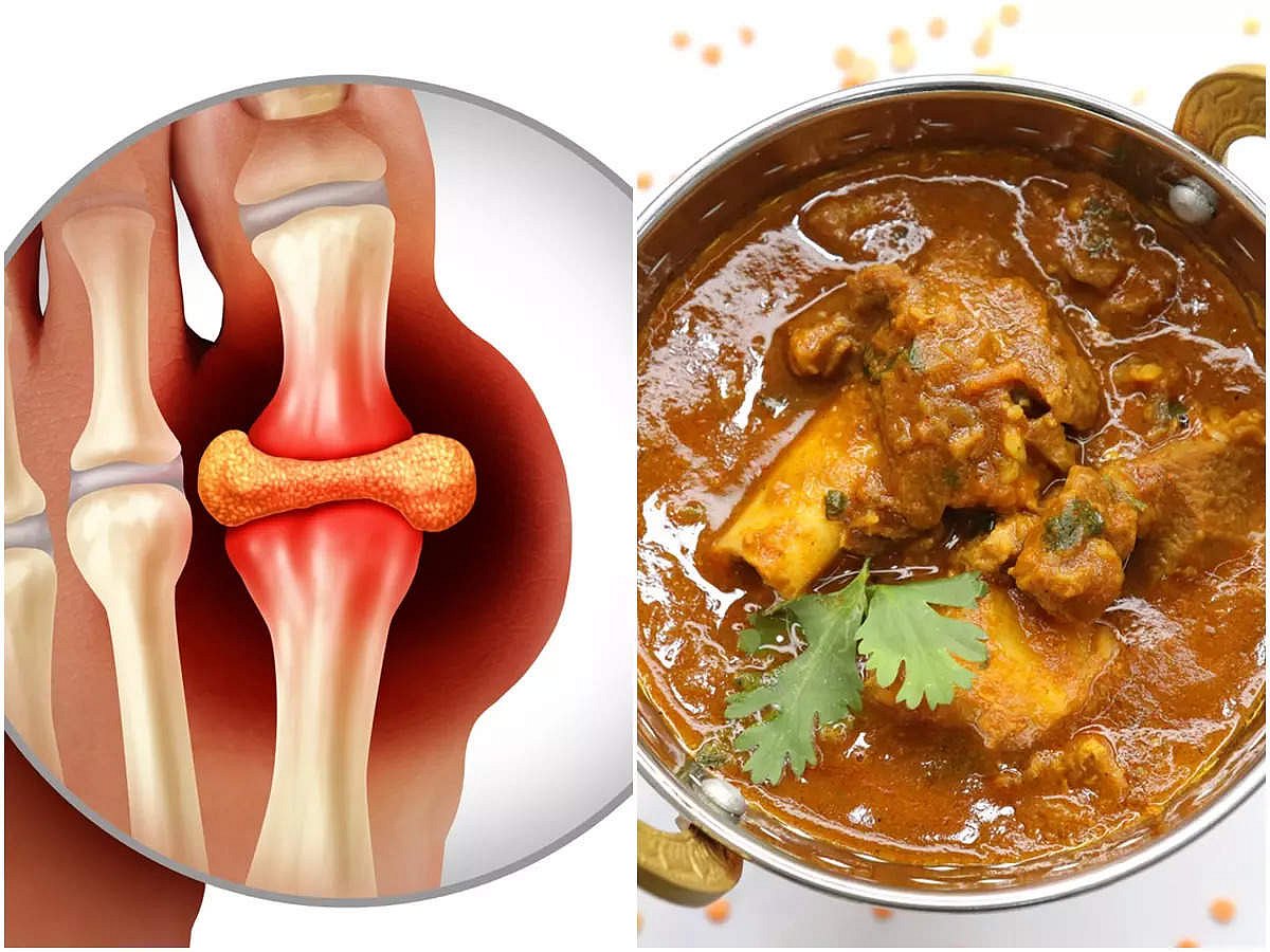 Worst Foods For Gout: ইউরিক অ্যাসিডের কারসাজিতে কি গাঁটে গাঁটে বেড়েছে ...
