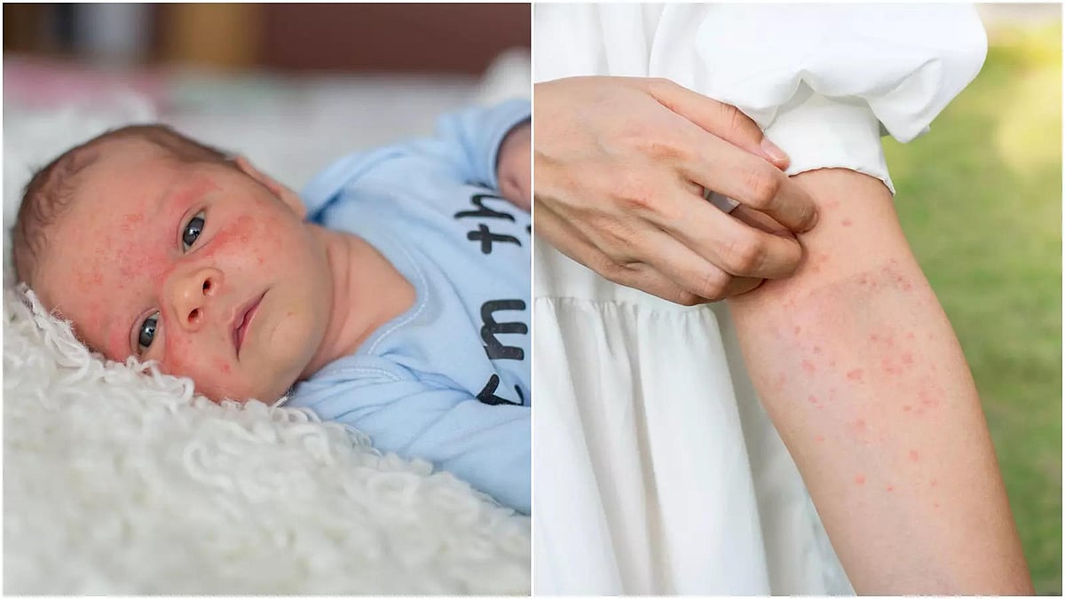 Heat Rash In Babies Home Remedies,Heat Rashes in Kids: ঘামাচির জ্বালায় ...