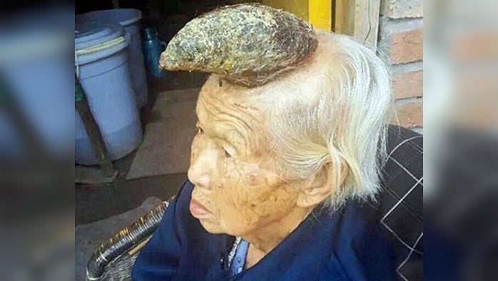 Cutaneous Horn,OMG! কেটে ফেললেও রাতারাতি গজাচ্ছে ঠাকুমার শিং - this old ...