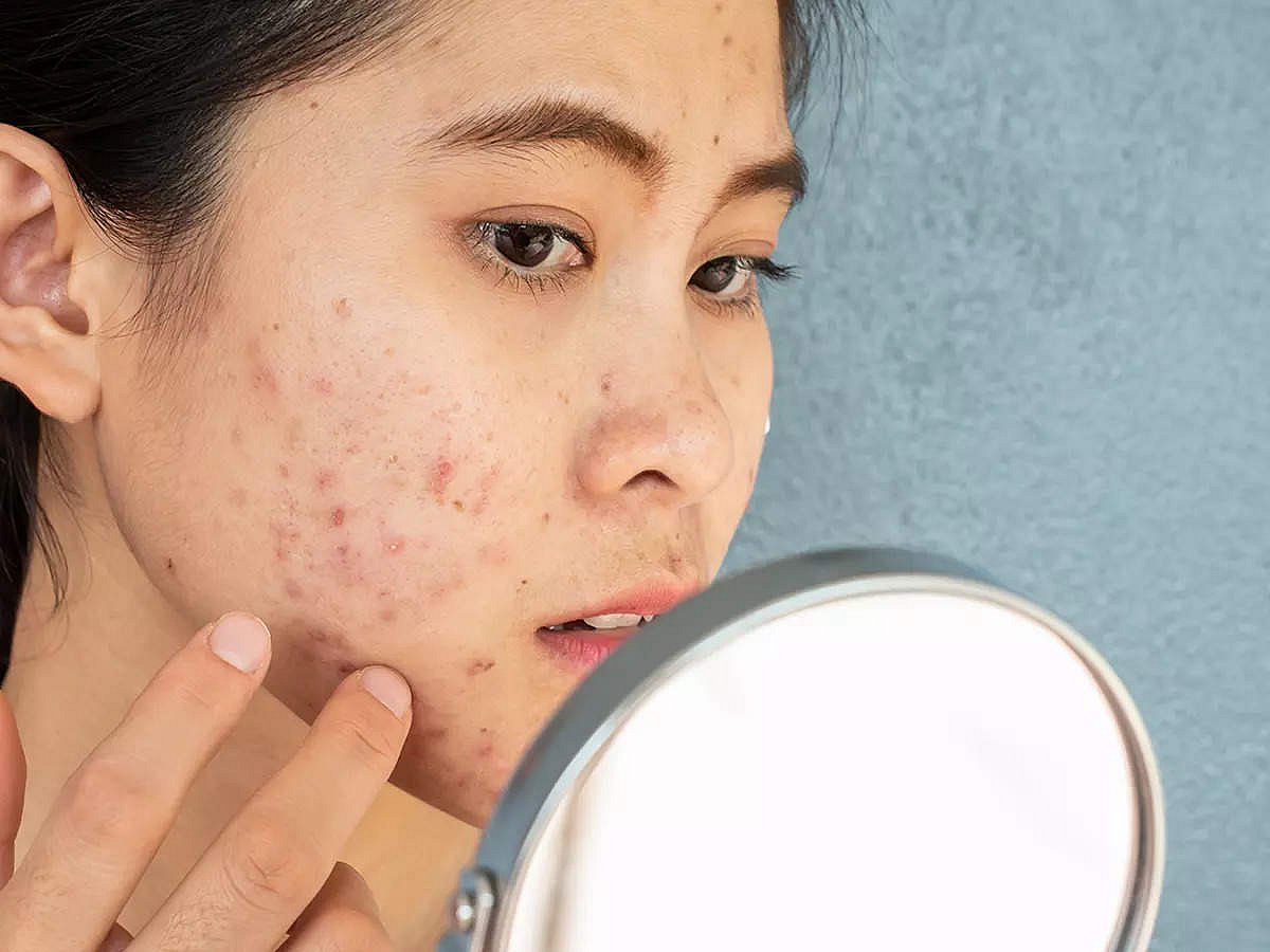 Postpartum Acne: ডেলিভারির পর মুখের শ্রী হারাচ্ছেন? আপনার জন্য রইল ...