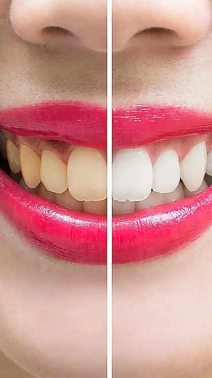 Teeth,কমলালেবুর খোসা দিয়ে দাঁত করে তুলুন ঝকঝকে - how to use orange ...