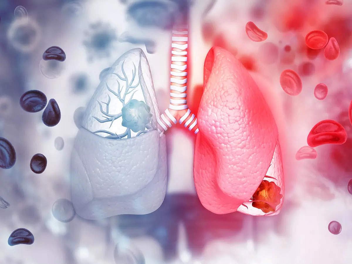 What Causes Copd Chronic Obstructive Pulmonary Disease Know From Who ...