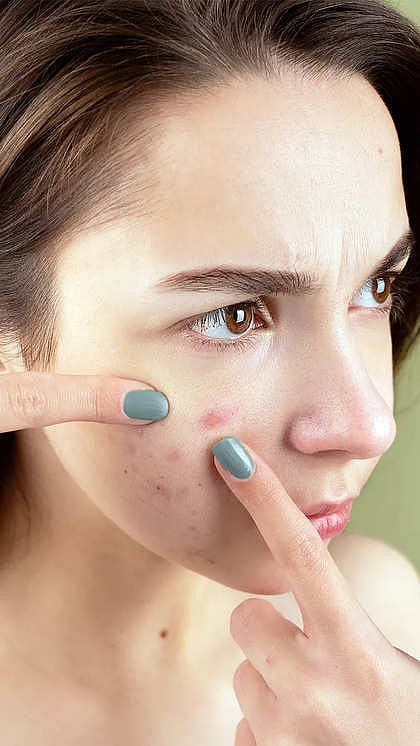 পিম্পল খুঁটে ফেলেছেন? জলদি জানুন এই টিপস - pimples on face removal tips ...