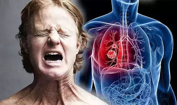 Lung cancer and its various symptoms