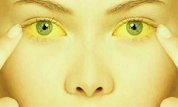Jaundice: Its Types, Causes, Symptoms & Some Remedies