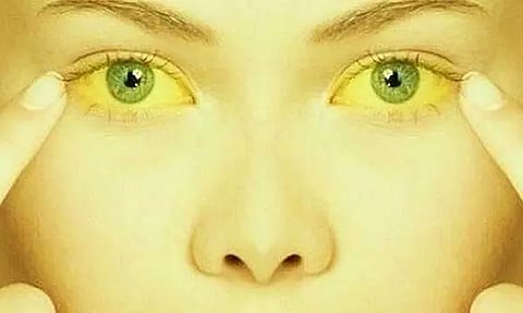 Jaundice: Its Types, Causes, Symptoms & Some Remedies