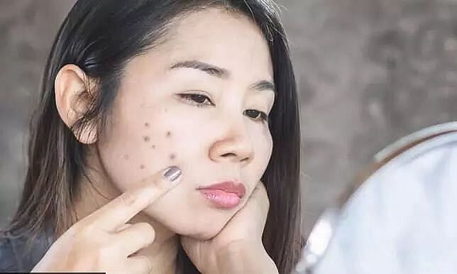 Know the Dark Spots on your Skin
