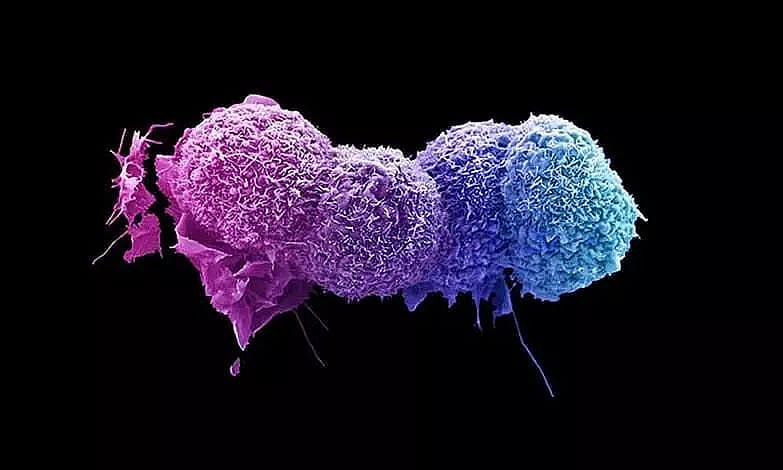 Researchers 3D bioprinted breast cancer tumors in new study